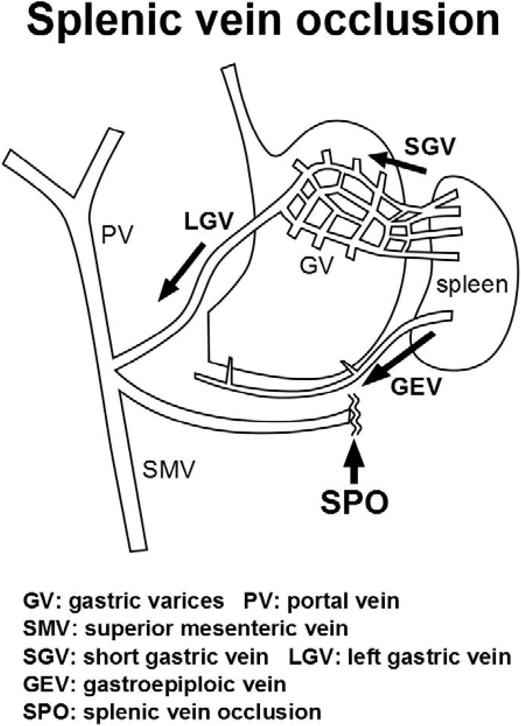 Endoscopic Color Doppler Ultrasonographic Evaluation of Gastric Varices Secondary to Left-Sided ...