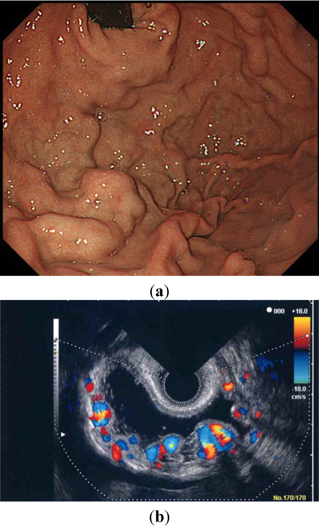 Diagnostics Free Full Text Endoscopic Color Doppler Ultrasonographic Evaluation Of Gastric