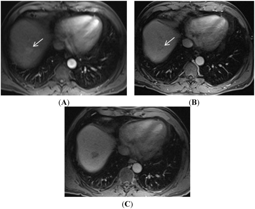 Contrast Enhanced MRI in the Diagnosis of HCC