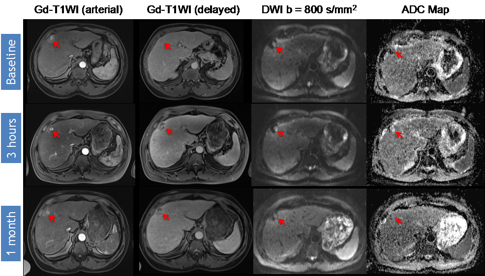 Diagnostics | Special Issue : Diagnosis of Hepatocellular Carcinoma Diagnostics | Special Issue : Diagnosis of Hepatocellular Carcinoma