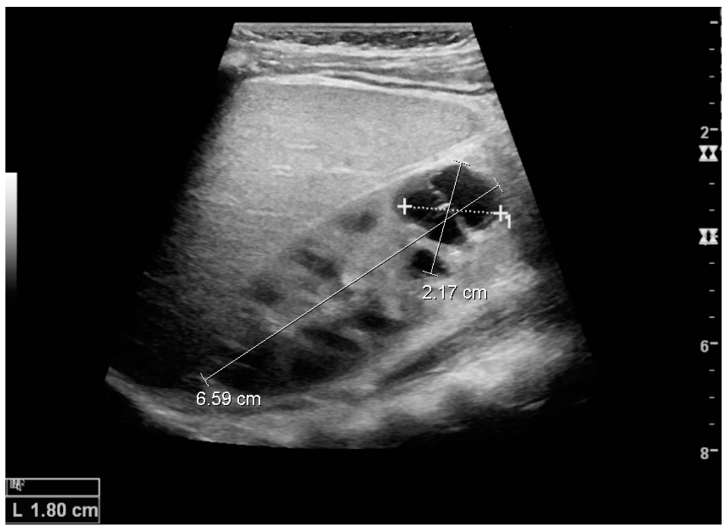 Ultrasonography of the Kidney: A Pictorial Review