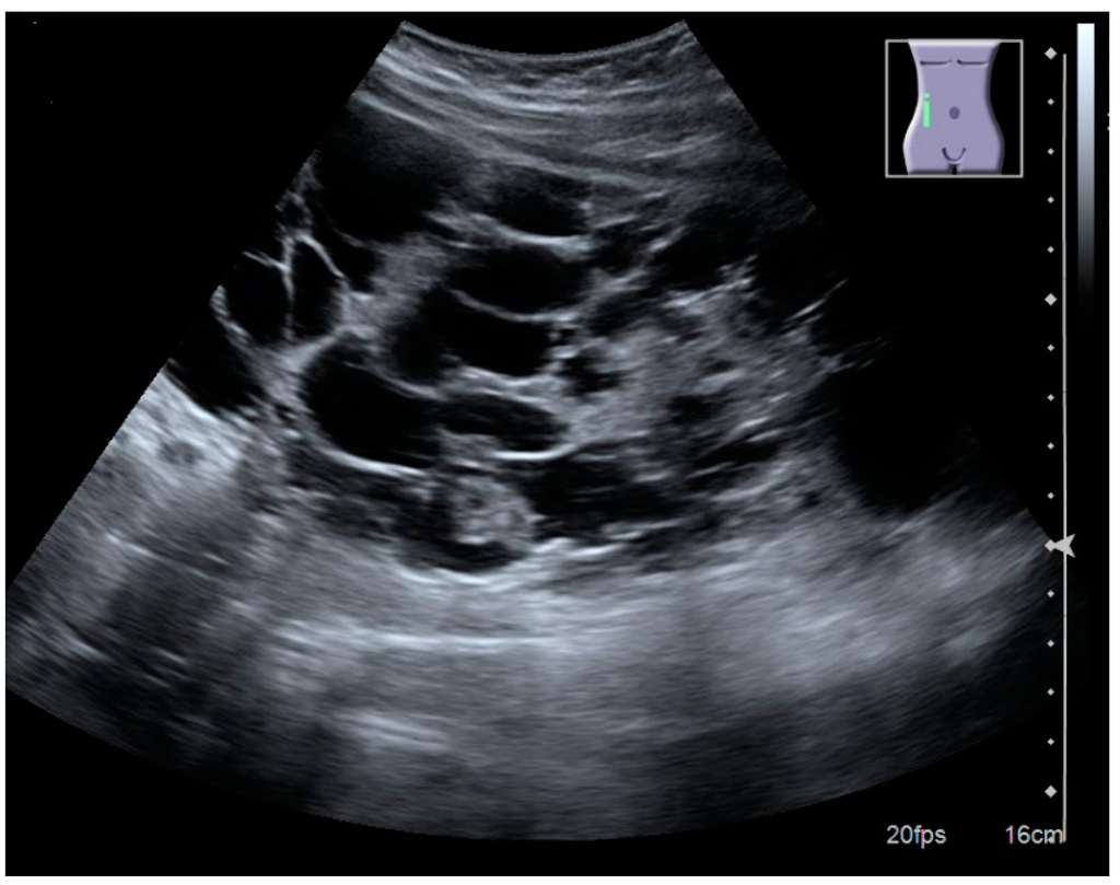 Ultrasonography of the Kidney: A Pictorial Review