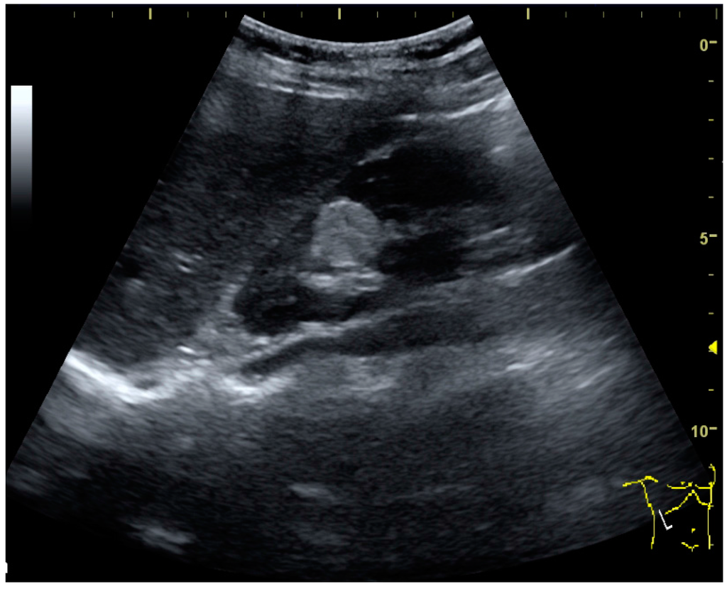 Ultrasonography of the Kidney: A Pictorial Review