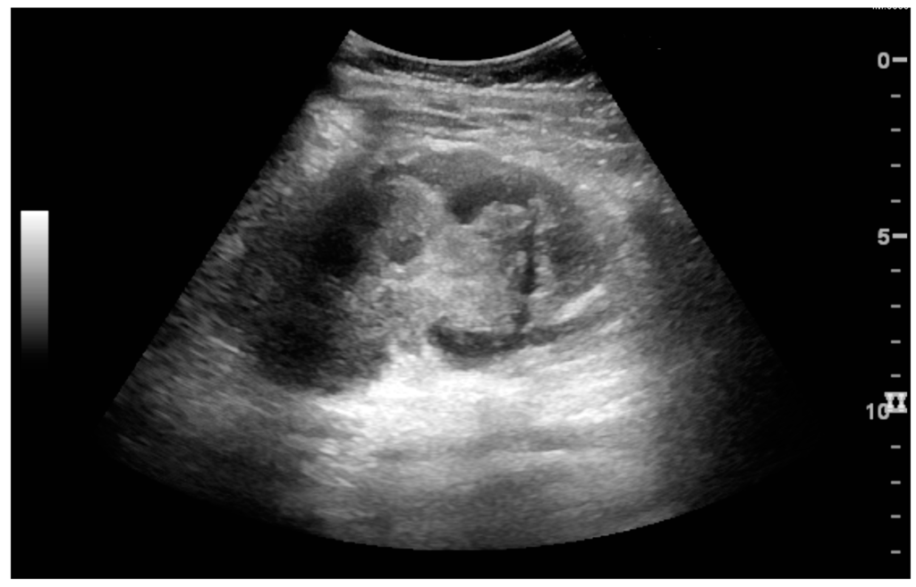 Ultrasonography of the Kidney: A Pictorial Review