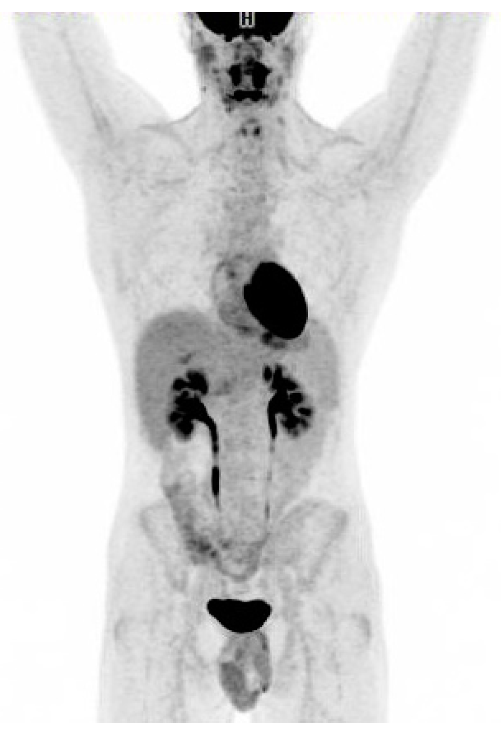 18F-FDG PET/CT Findings in Acute Epstein-Barr Virus Infection Mimicking ...