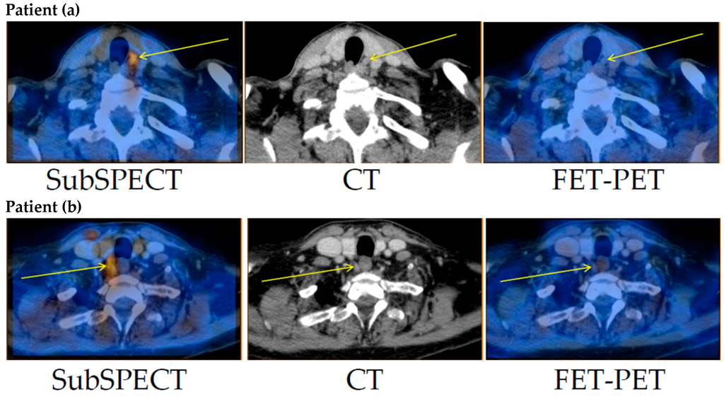 18F-FET-PET in Primary Hyperparathyroidism: A Pilot Study