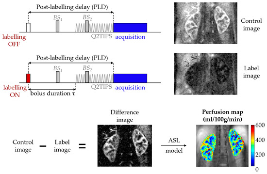 Non-Invasive Renal Perfusion Imaging Using Arterial Spin Labeling MRI ...