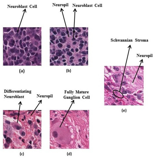Computer Aided Classification of Neuroblastoma Histological Images ...