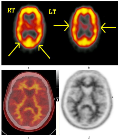 The Who, When, Why, and How of PET Amyloid Imaging in Management of ...