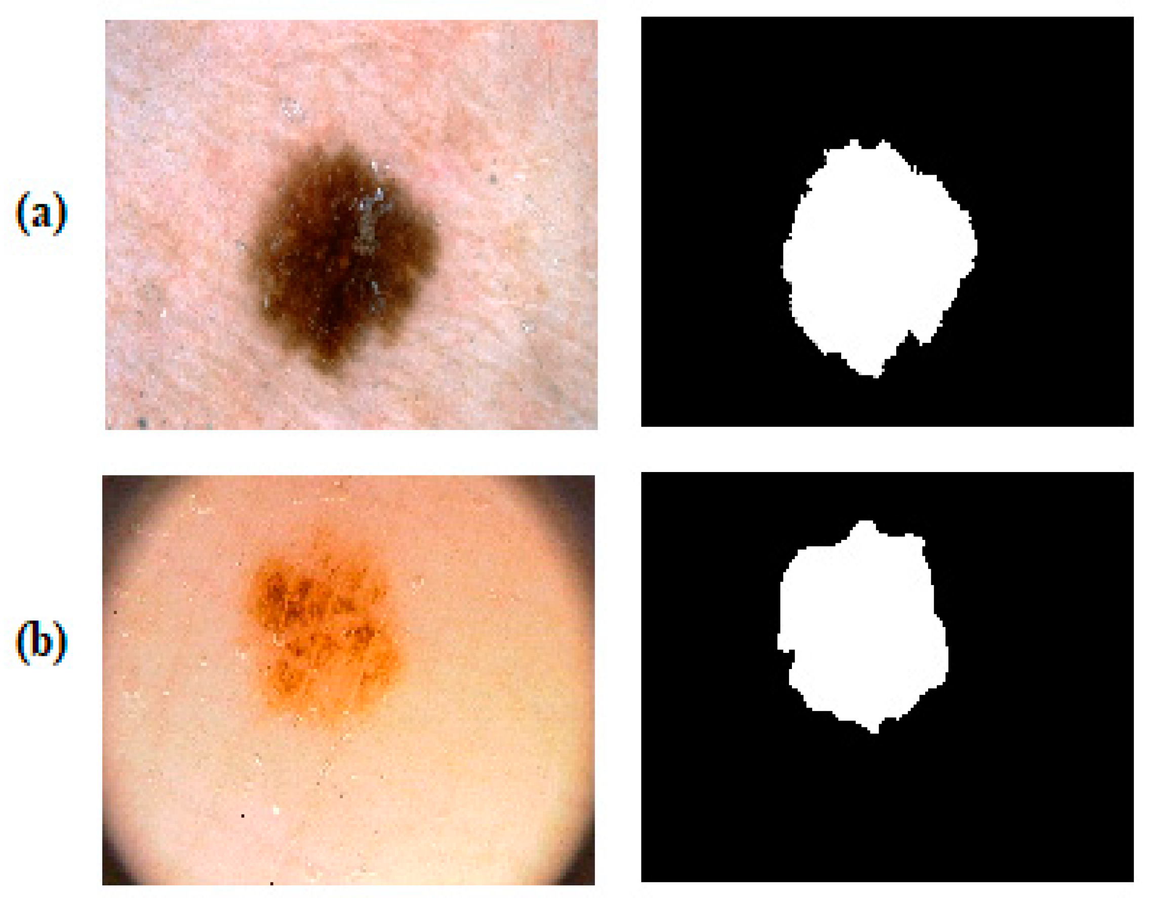 Skin Lesion Segmentation in Dermoscopic Images with Combination of YOLO and GrabCut Algorithm