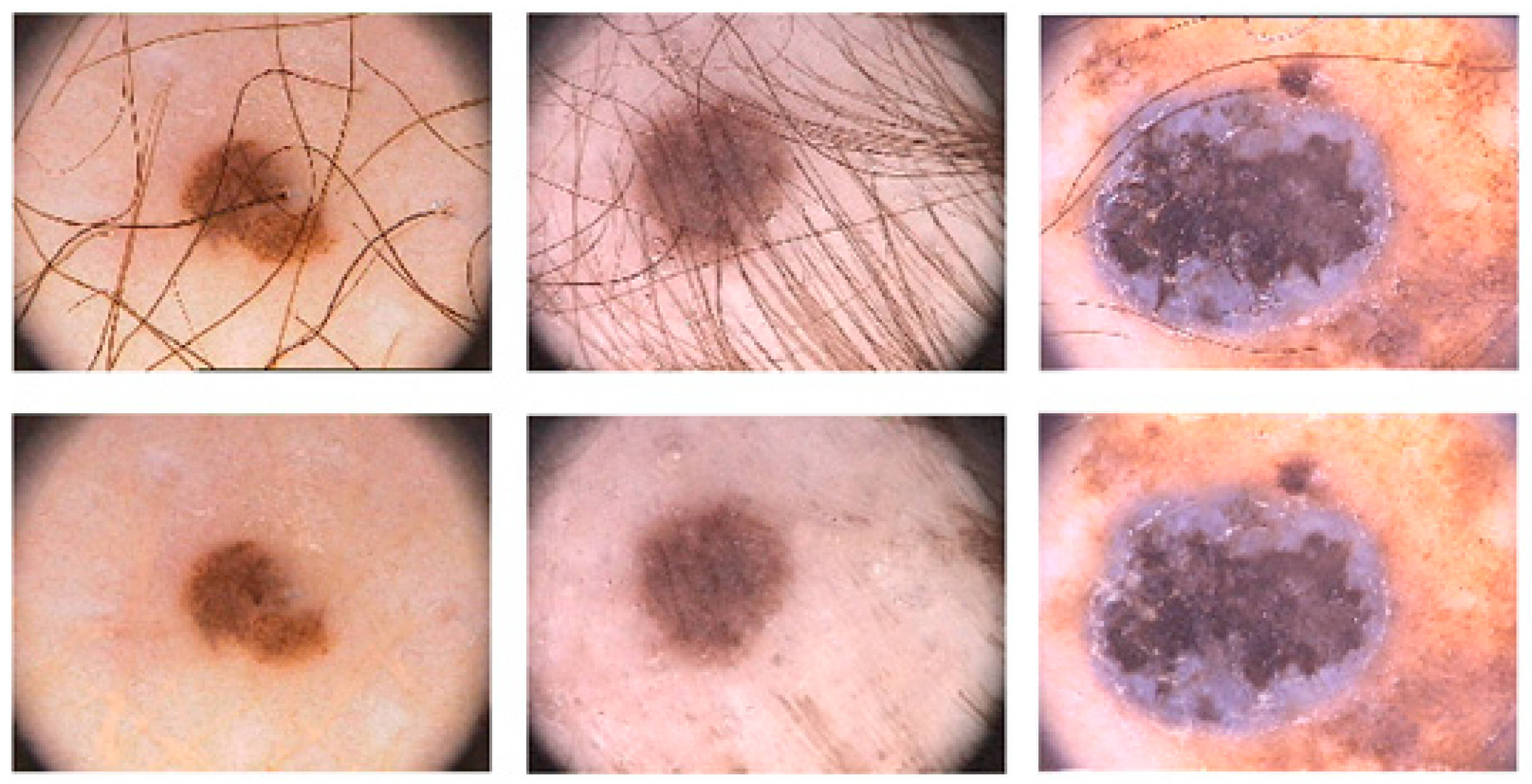 Skin Lesion Segmentation in Dermoscopic Images with Combination of YOLO ...
