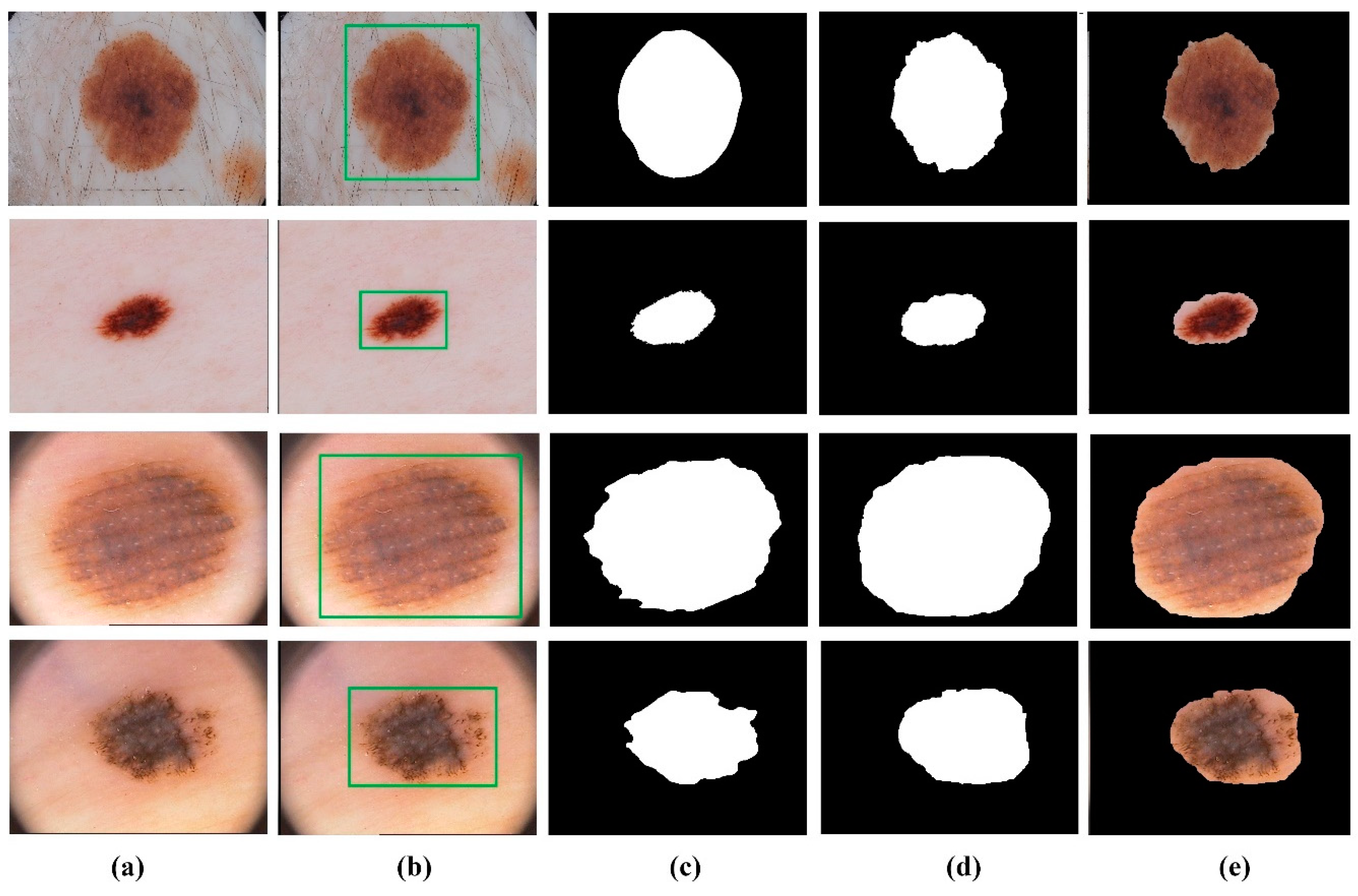 Skin Lesion Segmentation in Dermoscopic Images with Combination of YOLO and GrabCut Algorithm