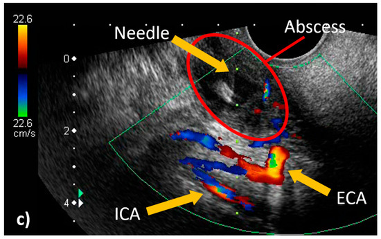 Ultrasound-Guided Needle Aspiration of Peritonsillar Abscesses: Utility ...