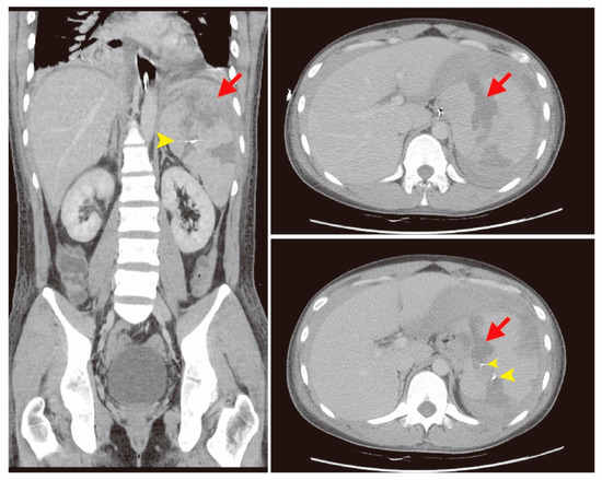 Spontaneous Splenic Rupture as a Rare Initial Presentation in an Acute ...