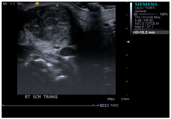 Changes in Muscle Stiffness in Infants with Congenital Muscular Torticollis