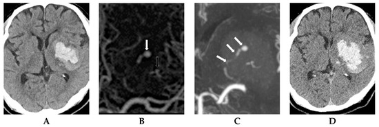 Correlation between Spot Sign and Intracranial Hemorrhage Expansion on ...