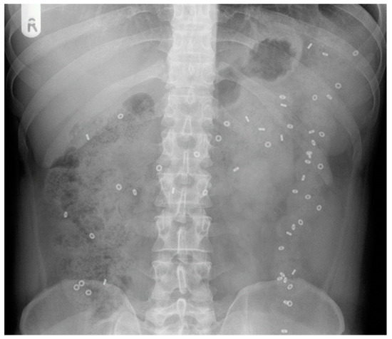 Diagnostics | Free Full-Text | Imaging Measurement of Whole Gut Transit ...
