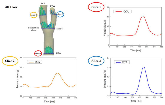 Four-Dimensional Flow Magnetic Resonance Imaging for Assessment of ...