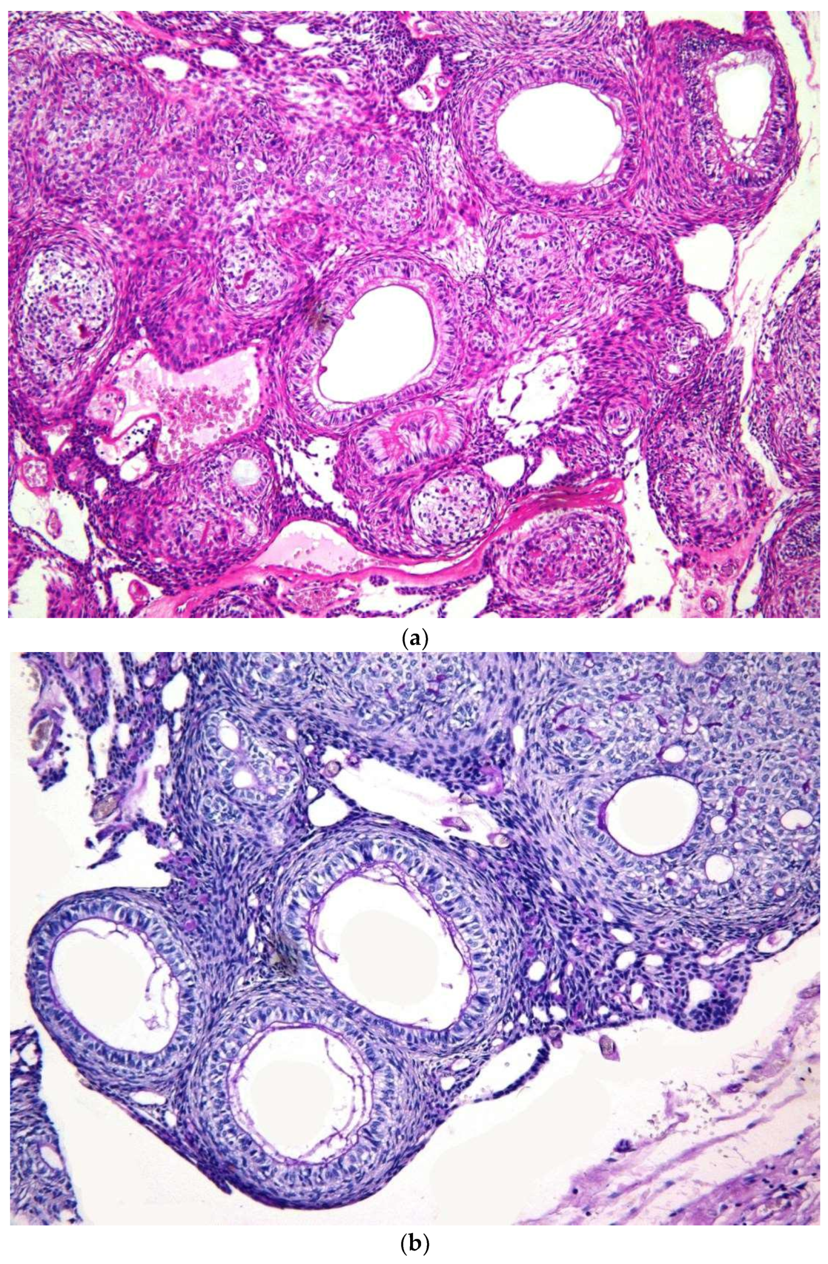 Clinico Pathological Presentations Of Cystic And Classic Adenomatoid