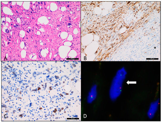 First Glance of Molecular Profile of Atypical Cellular Angiofibroma ...