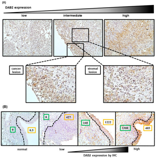 Disabled Homolog 2 (DAB2) Protein in Tumor Microenvironment Correlates ...