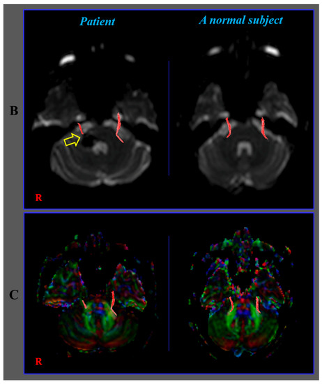 Diagnosis of the Trigeminal Nerve Injury in a Patient with Pontine ...