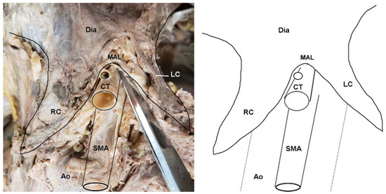 The Roles of Celiac Trunk Angle and Vertebral Origin in Median Arcuate ...