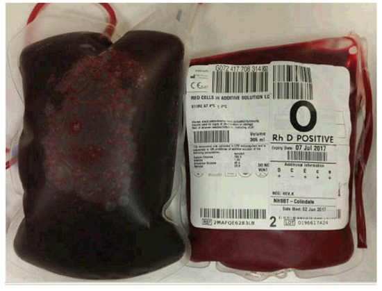 The Diagnosis of Sulfated Hemoglobin (SulfHb) Secondary to Sulfur ...