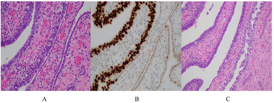 Serous Tubal Intraepithelial Carcinoma: A Concise Review for the ...