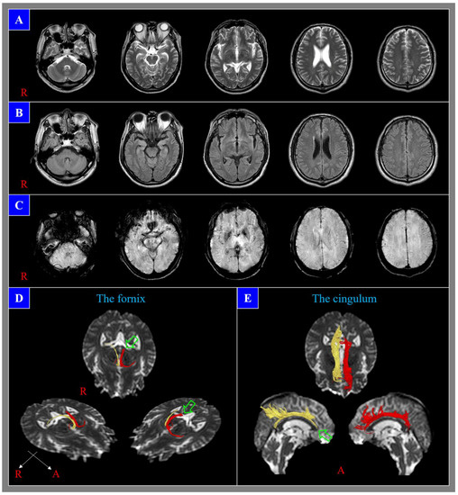 Diagnostics | Free Full-Text | Diagnostic Problems in Diffuse Axonal Injury