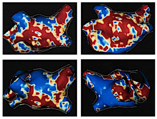 Left Atrial Structural Remodelling in Non-Valvular Atrial Fibrillation ...