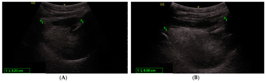 Clinical versus Ultrasound Measurements of Hyomental Distance Ratio for ...