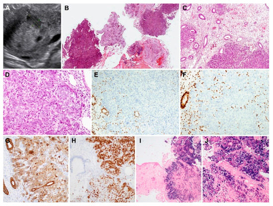 Endometrium-Limited Metastasis of Extragenital Malignancies: A ...