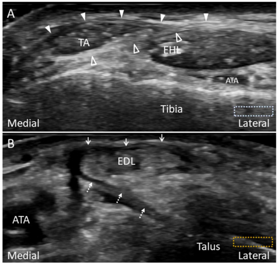 Advanced Ankle and Foot Sonoanatomy: Imaging Beyond the Basics