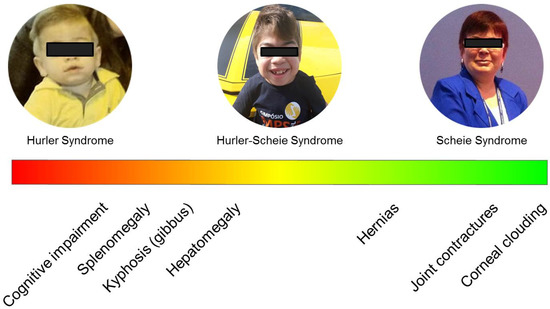 Mucopolysaccharidosis Type I