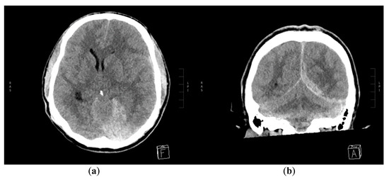 Acute Tentorial Subdural Hematoma Caused by Rupture of the Posterior ...