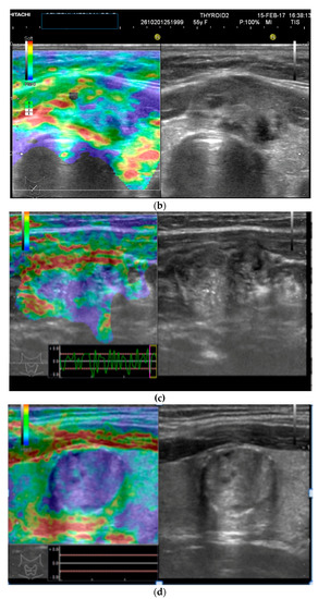 TI-RADS Diagnostic Performance: Which Algorithm Is Superior and How ...