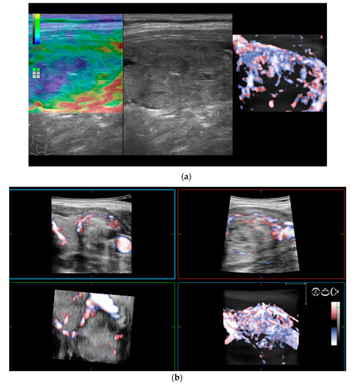 TI-RADS Diagnostic Performance: Which Algorithm Is Superior and How ...