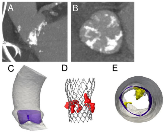 A Finite Element Analysis Study from 3D CT to Predict Transcatheter ...