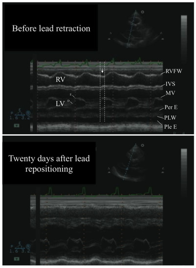 Diagnostics | Free Full-Text | Minimal Cardiac Perforation by Lead ...