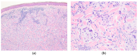 Epithelioid Cutaneous Mesenchymal Neoplasms: A Practical Diagnostic ...