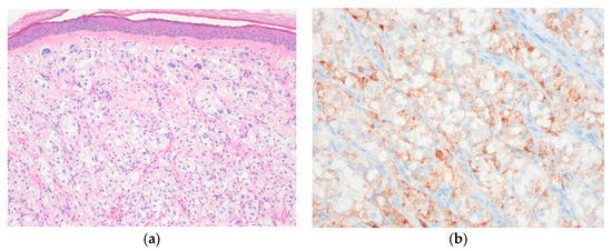 Epithelioid Cutaneous Mesenchymal Neoplasms: A Practical Diagnostic ...