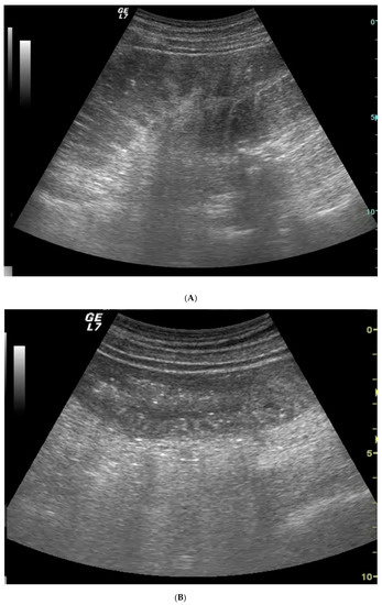 Ultrasound Signs in the Diagnosis and Staging of Small Bowel Obstruction