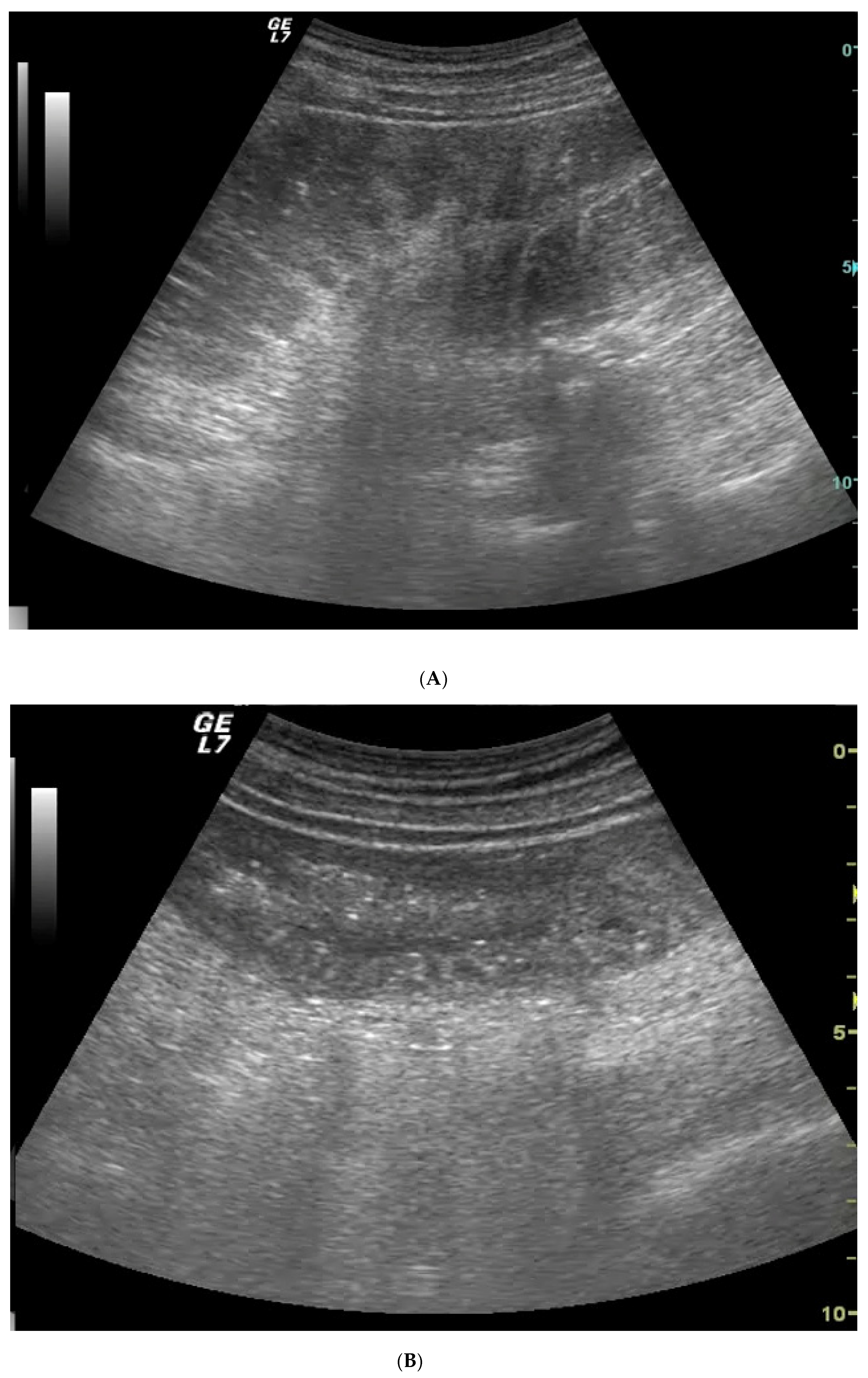 Ultrasound Signs in the Diagnosis and Staging of Small Bowel Obstruction