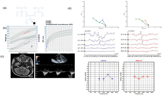 Novel Splice Site Pathogenic Variant of EFTUD2 Is Associated with ...