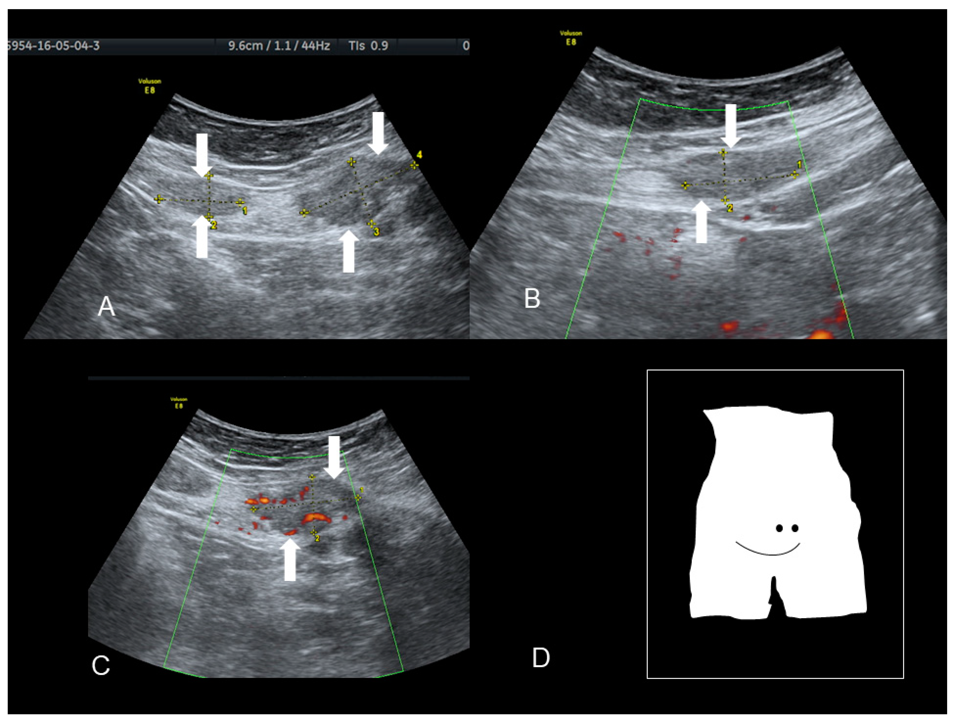 Ultrasonography and Atypical Sites of Endometriosis