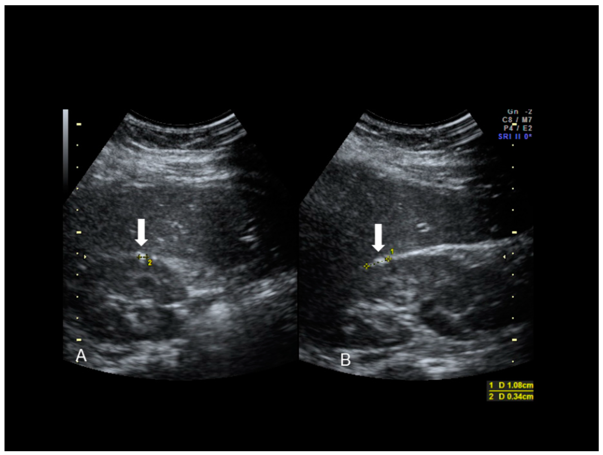 Endometritis Ultrasound