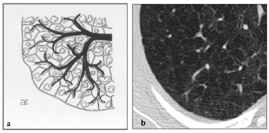 Cystic Interstitial Lung Diseases: A Pictorial Review and a Practical ...