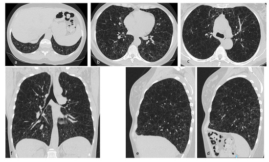 Cystic Interstitial Lung Diseases: A Pictorial Review and a Practical ...
