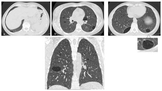 Cystic Interstitial Lung Diseases: A Pictorial Review and a Practical ...